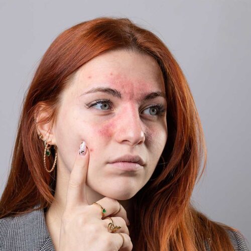 Effective Treatment of Rosacea and Couperosis | Dr Bernier